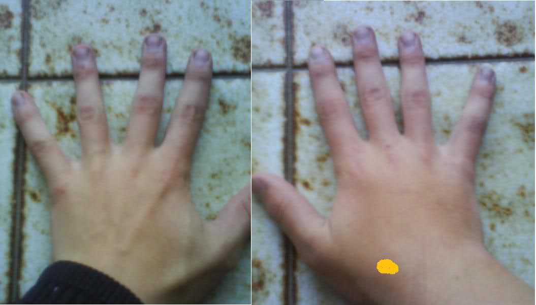 Gekneusde Handen Tumblr Stockfoto's Van Gevouwen Handen, Rechtenvrije