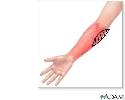 elleboog/onderarm blessure | Bodybuilding.nl Forum