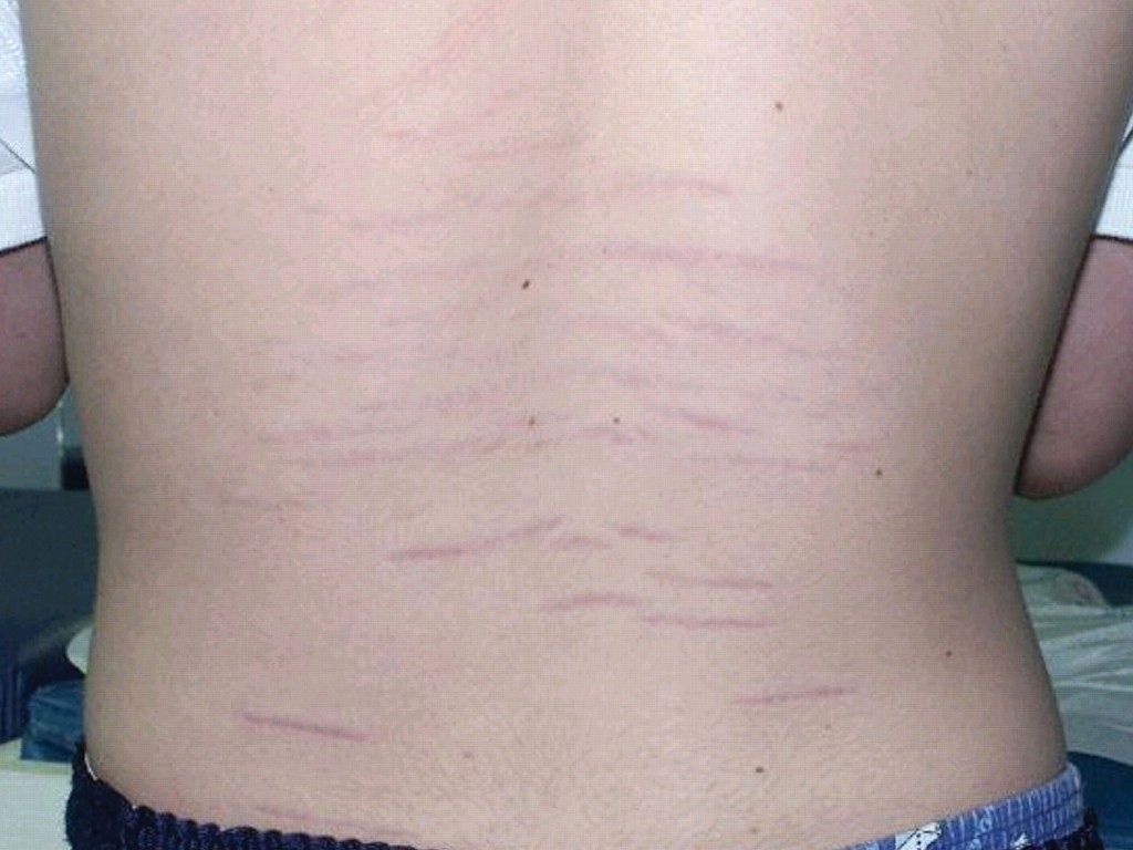 strepen op rug | Bodybuilding.nl Forum